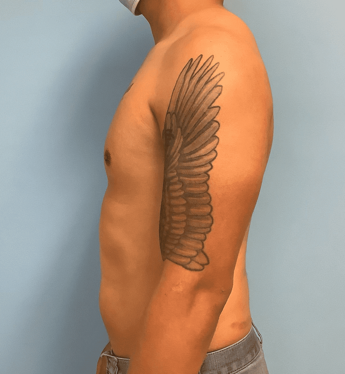 GYNECOMASTIA CASE #3808 | Carolina Plastic Surgery