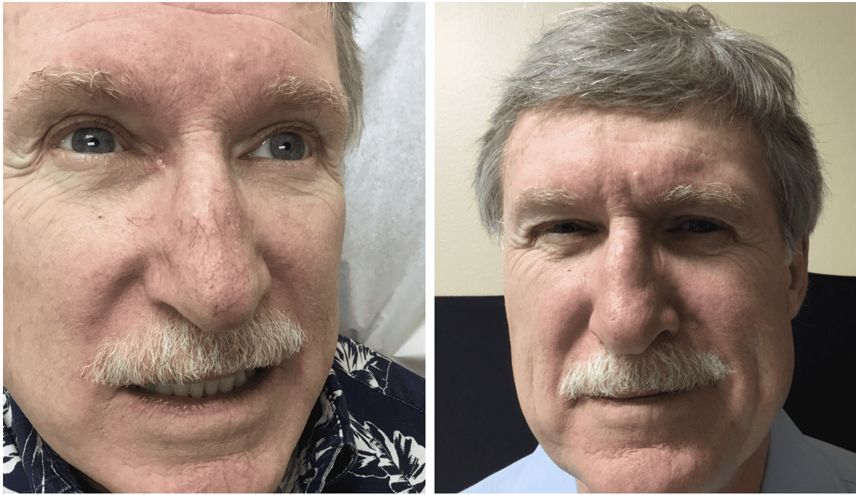 PALOMAR ICON LASER CASE #2053 | Carolina Plastic Surgery