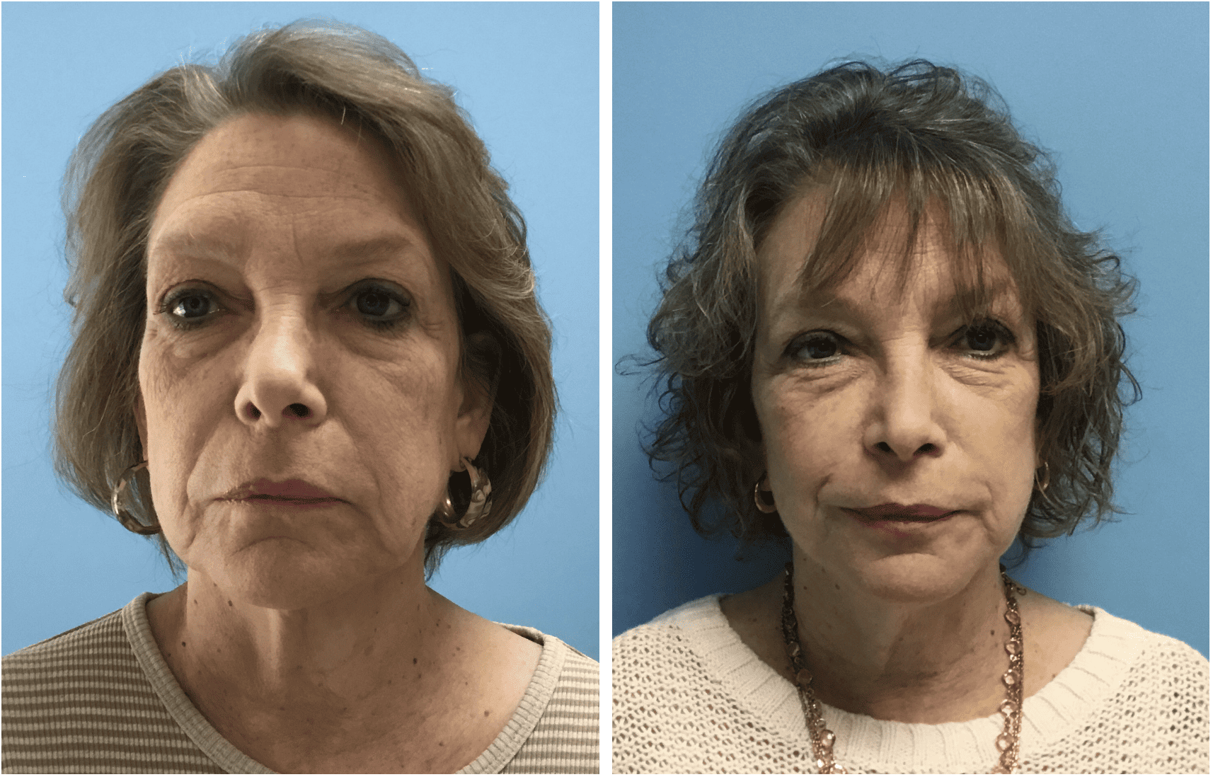 FACELIFT CASE #2016 | Carolina Plastic Surgery